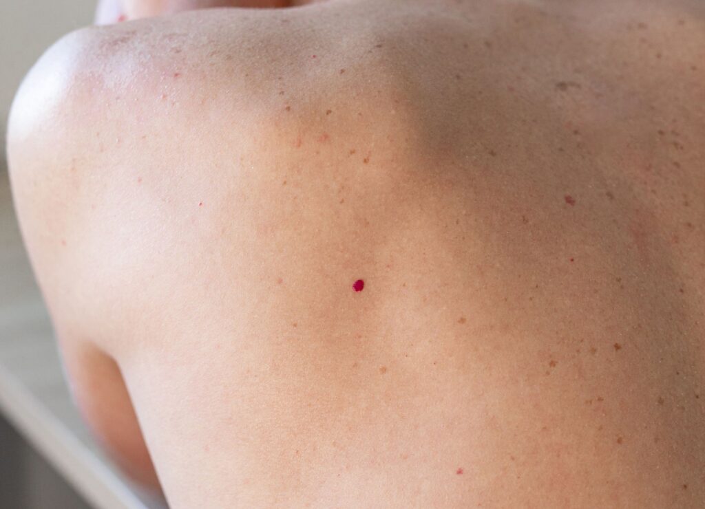 Traitement taches rubis ou angiomes à Paris | Cabinet Laser Médical Paris